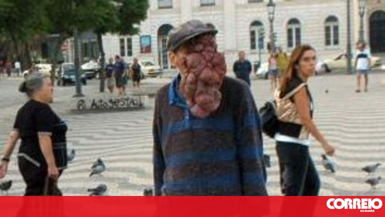 Homem 'sem rosto' do Rossio remove tumor de 5,5 quilos - Sociedade ...