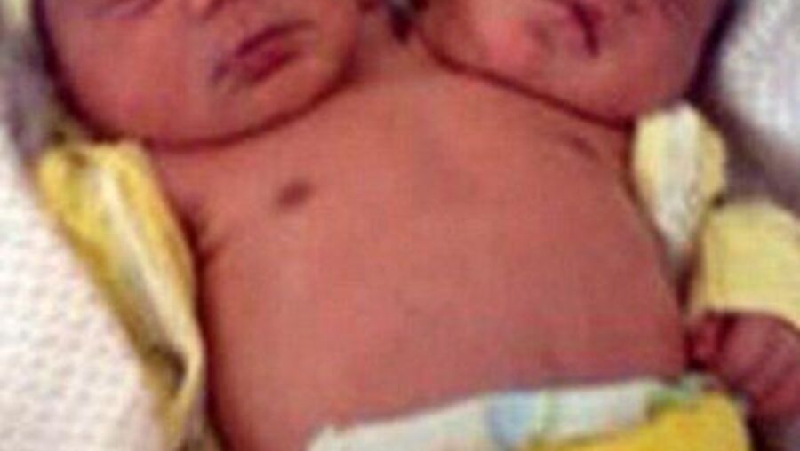 Gémeos siameses com duas cabeças - Mundo - Correio da Manhã