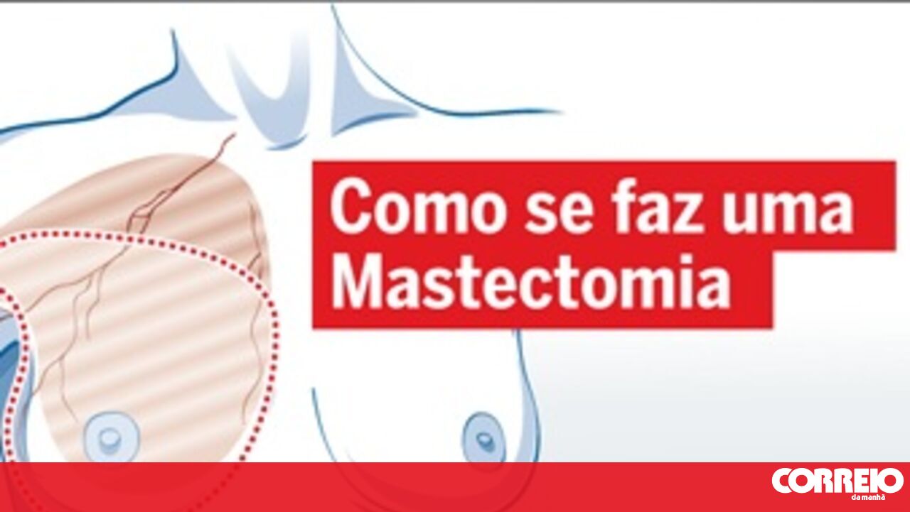 Saiba o que é uma mastectomia - Sociedade - Correio da Manhã