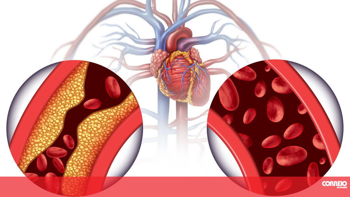 Doença coronária: o que é e como se trata - Trofa Saúde - Correio da Manhã