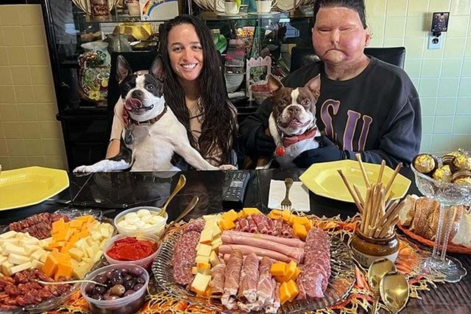 Jovem com transplante de rosto e mãos revela que encontrou o amor cinco ...